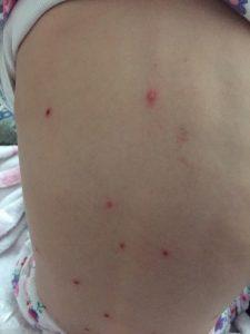 Chickenpox - What You Need To Know & How We Treated It • A Moment With ...