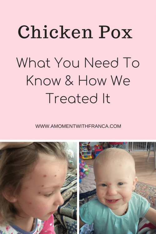 Chickenpox - What You Need To Know & How We Treated It • A Moment With ...
